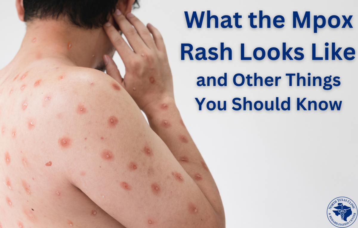 What an Mpox Rash Looks Like and Other Things You Should Know